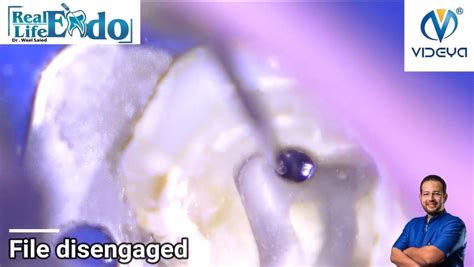 Ultrasonic Broken File Retrievalknowledgehuizhou Videya Technology Co