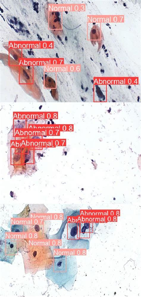 Figure 11 From Comparative Analysis Of Object Detection Strategies For Cervical Cancer Detection