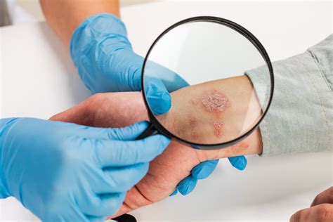 Does Alcohol Kill Ringworm On Surfaces In Chicago