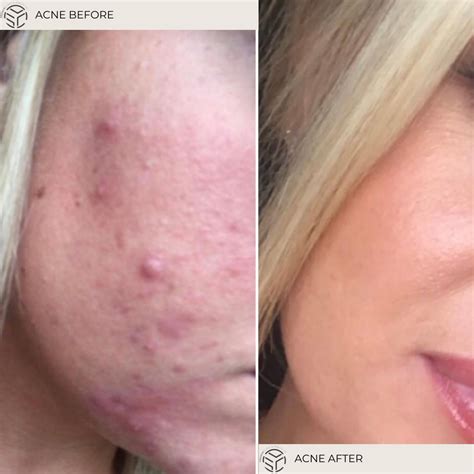Acne Management Treatment Proskin Clinic And Health Uk Gloucester