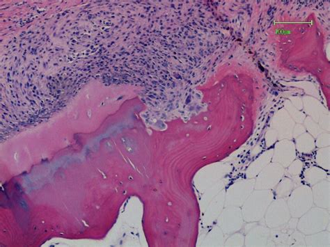The Richly Cellular Pannus Has Penetrated All Layers Of The Articular