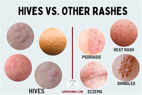 Rubeola Rash