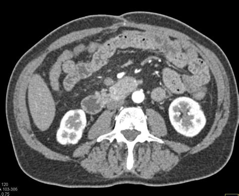GIST Tumor Arising Off The 4th Portion Of The Duodenum Small Bowel