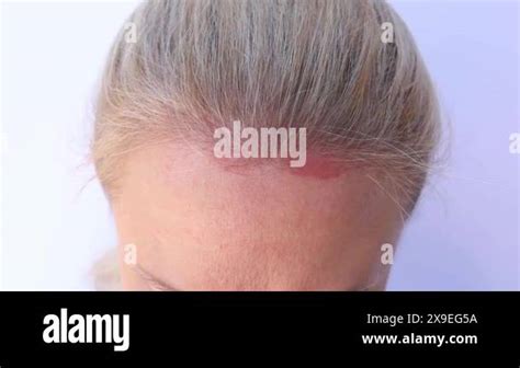 Dermatitis Solar Stock Videos And Footage Hd And 4k Video Clips Alamy