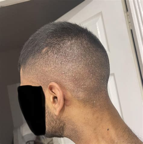 Scalp Folliculitis Rfolliculitis