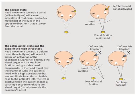 Cme 160114 Vestibular And Vertigo Assessment Charlies Ed