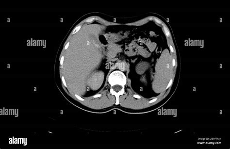 Abdomen Human Man CT Scan Stock Photo Alamy