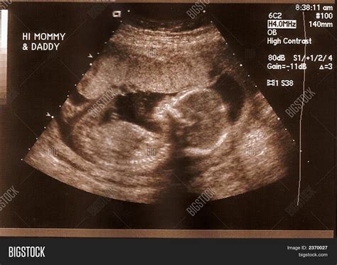 Ultrasound 18 Weeks Image And Photo Bigstock