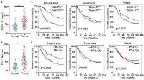 Tumor Stroma Siglec15 Expression Is A Poor Prognosis Predictor In Colon Adenocarcinoma