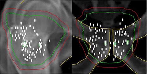 Locations Of Implanted Fiducial Markers In 23 Patients Need For Set Up Download Scientific
