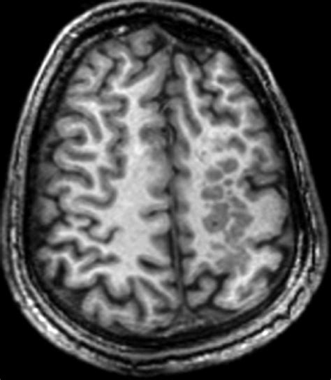 Subcortical Heterotopia T1 Spgr Spoiled Gradient Recalled Echo In Download Scientific