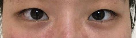 시술 수술 질문 예쁜 쌍커풀 라인이 강남언니 1등 성형수술and피부시술 정보앱