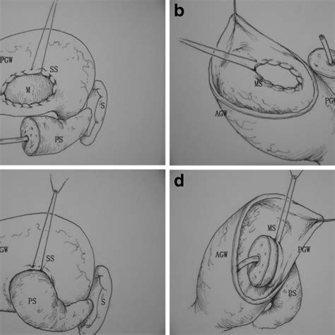 A A Seromuscular Continuous Hemstitch Suture Seromuscular Suture Ss