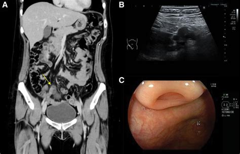 Laparoscopic Resection For Appendiceal Mucocele Secondary To