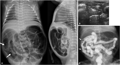 Gastrointestinal Emergency In Neonates And Infants A Pictorial Essay