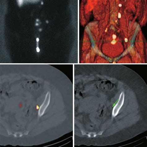 Pdf Uncommon Applications Of Sentinel Lymph Node Mapping Urogenital