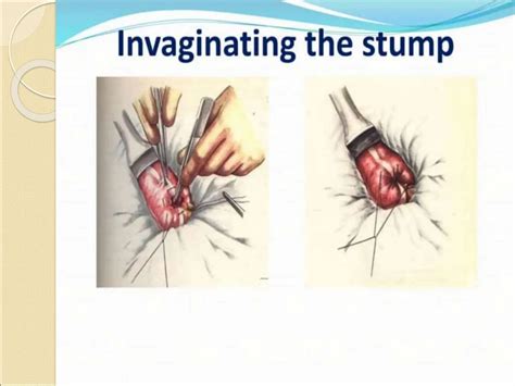 Appendicitis Clinical Sign Symptoms And Management Ppt