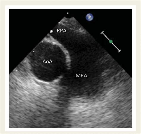 Short Axis View Of Ascending Aorta And Main Pulmonary Artery Mpa