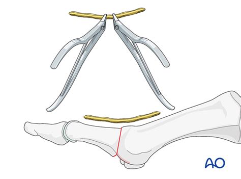 Mtp Joint Fusion For Complete Articular Fractures Of The Proximal Hallux
