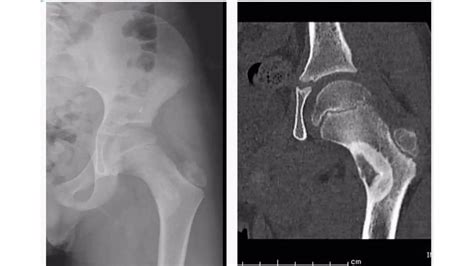 Benign Bone Lesions X Ray Radiology Guidepdf