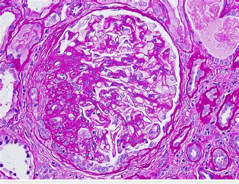 Enlarged Glomerulus Showing Mild Mesangial Expansion And A Segmental Download Scientific