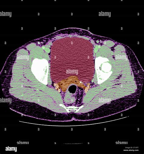 BLADDER SCAN Stock Photo Alamy