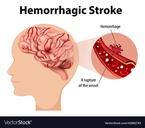 Human With Hemorrhagic Stroke Royalty Free Vector Image