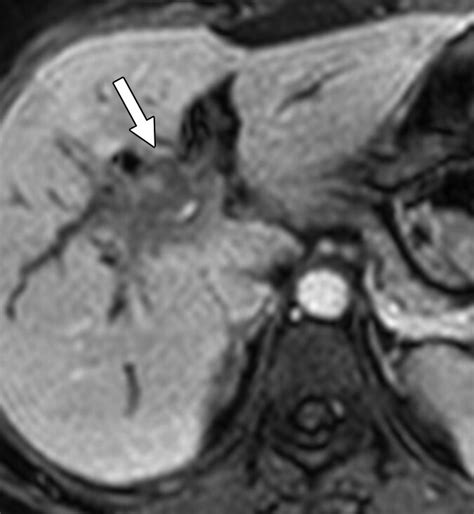 Igg4 Related Sclerosing Cholangitis A Clinical And Imaging Review Ajr