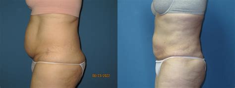 Liposuction Abdomen Flanks Before And After Pictures Case 175 Coeur