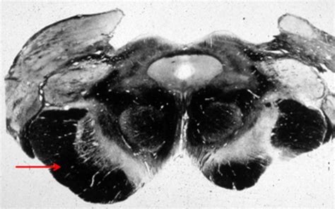 Brainstem Lecture Flashcards Quizlet