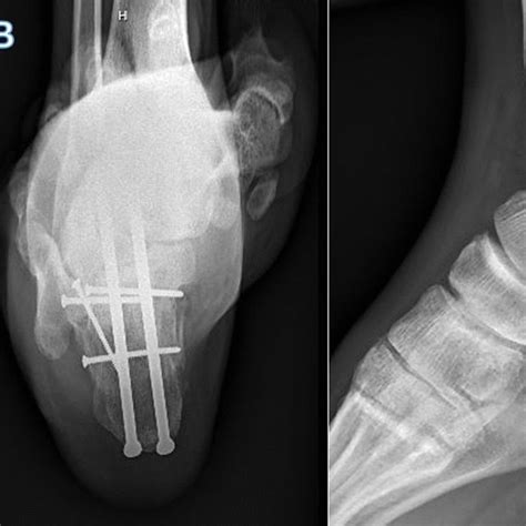 Treatment Algorithm For Displaced Intraarticular Calcaneal Fractures Download Scientific