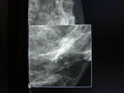 impact of digital mammography in the detection and management of