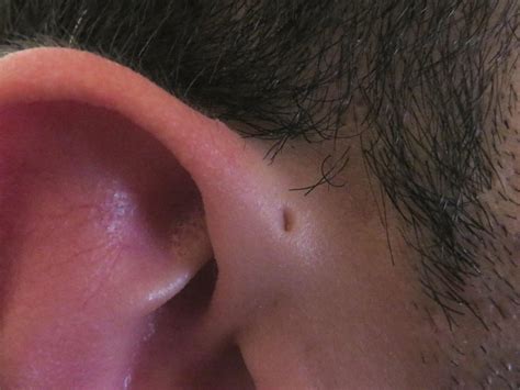 Bump Or Lump In Or Around The Ear Causes And Treatments