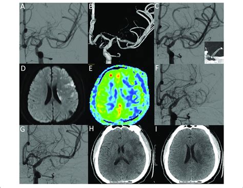 A 28 Year Old Male With A Significant Symptomatic Stenosis Of The Download Scientific Diagram