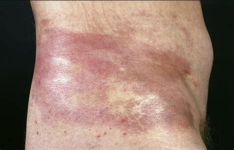 Localized Scleroderma Dermatologist Consultation Online Iderma