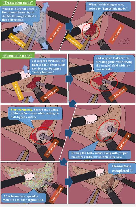 Figure 1 From The Impact Of Modified Two Surgeon Technique For