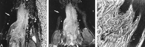 A Fast Spin Echo T2 Weighted Image 4000 99 4 Shows Severe Artifacts Download Scientific