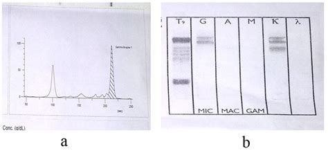 A Serum Protein Electrophoresis Showing M Spike In Gamma Globulin