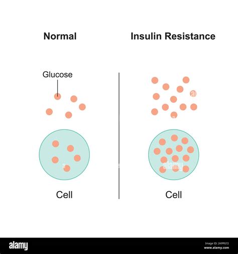 Insulin Resistance Concept Design Vector Illustration Stock Vector Image And Art Alamy