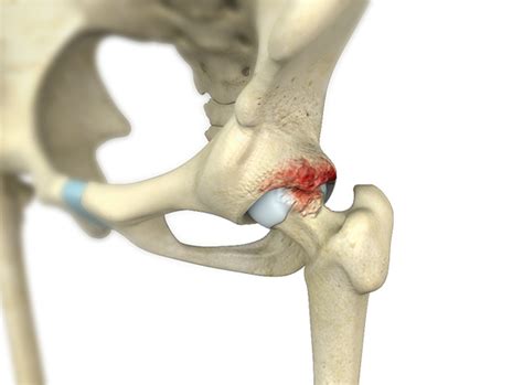 Hip Surgery Memphis Hip Arthroscopy Memphis Hip Replacement Memphis