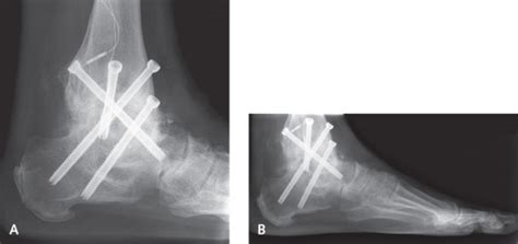 Tibiotalocalcaneal And Pantalar Arthrodesis Musculoskeletal Key