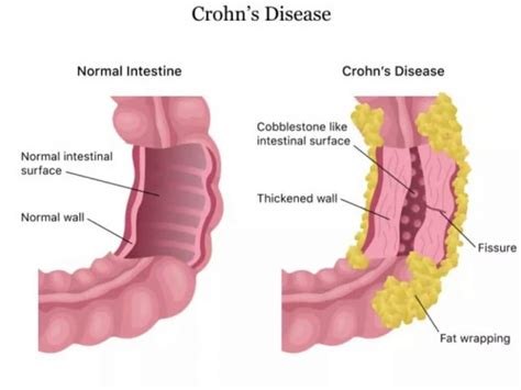 Bệnh Crohn Là Bệnh Gì Có Di Truyền Không Có Lây Không