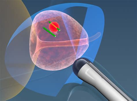Transrectal Biopsy For Prostate Cancer Detection Koelis