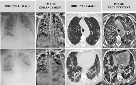 Image Enhancement Using Contrast Limited Adaptive Histogram Equalization Download Scientific