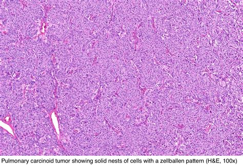 Pathology Outlines Typical Carcinoid Tumor Neuroendocrine Tumor