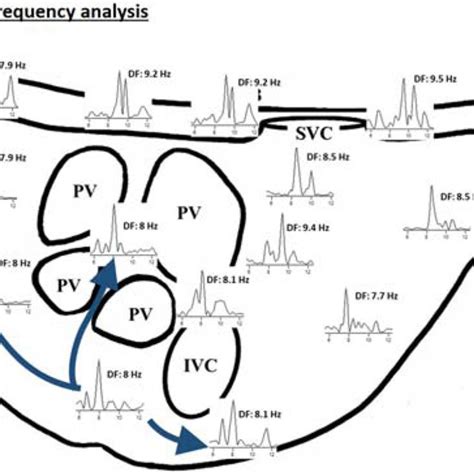 Pdf Reconsidering The Multiple Wavelet Hypothesis Of Atrial Fibrillation