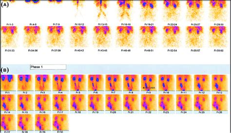A The Perfusion Phase Of Scintigraphy For 60 Seconds After Injection