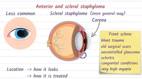 Staphyloma Posterior Vs Anterior Symptoms And Treatment Eye