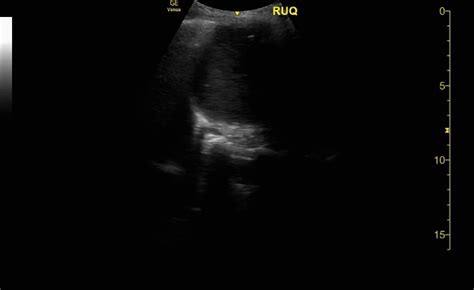 Efast — Cook County Emergency Medicine Residency