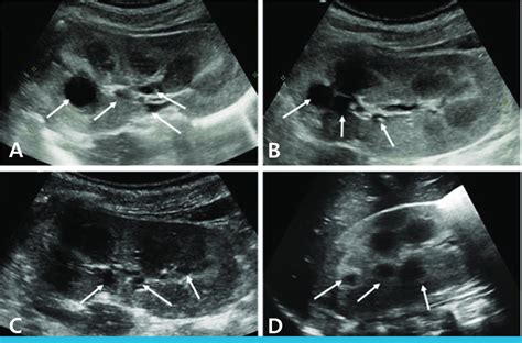 Renal Ultrasonography The Ultrasound Pictures Of Both Boys Show Large